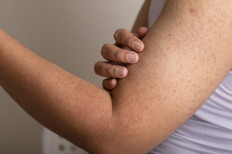 Best Creams for "Chicken Skin" & Keratosis Pilaris · Care to Beauty