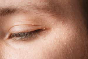 How to Prevent Milia Bumps: 3 Simple Tips · Care to Beauty